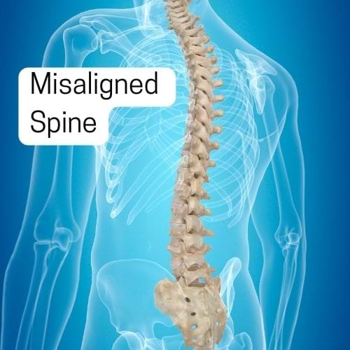 A misaligned spine
