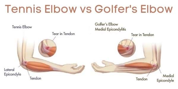 Tennis Elbow and Golfer's Elbow